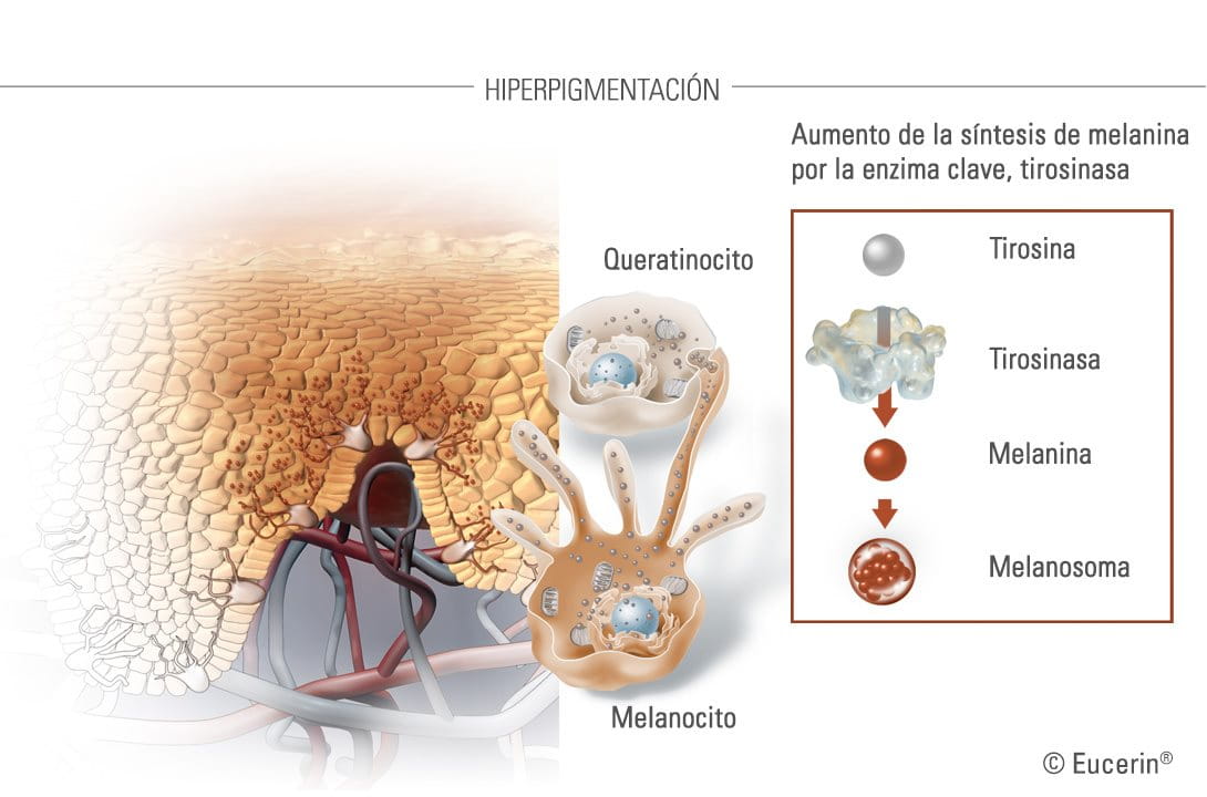 hyperpigmentation-caused-by-inflammation